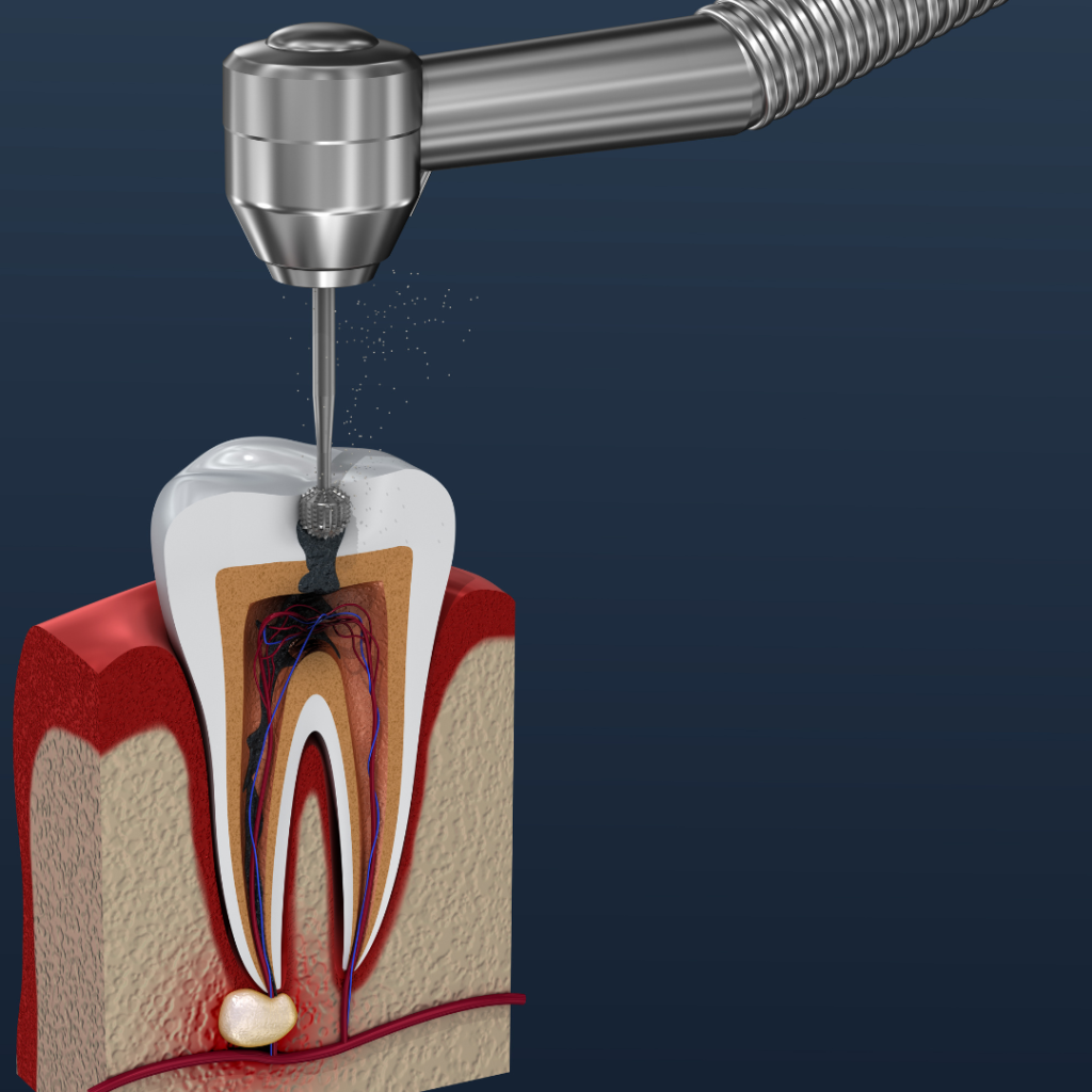 Root canal treatment (RCT)